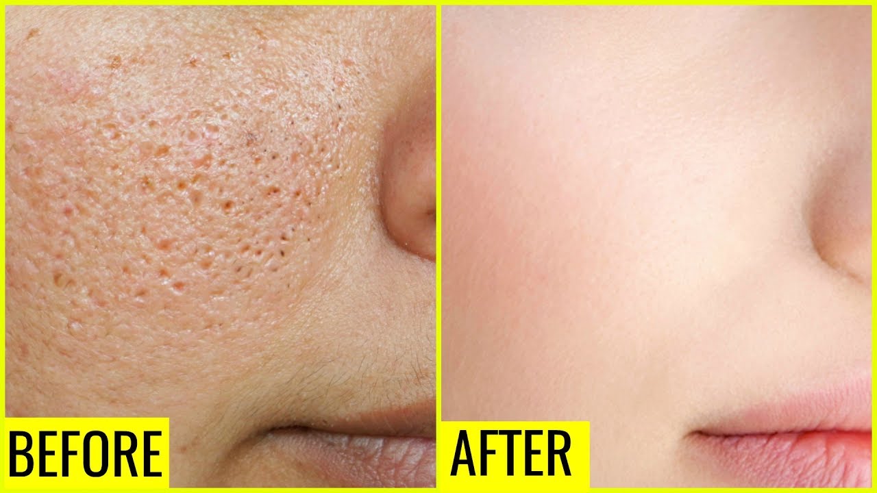 Open Pores Comprehensive Treatment Plan - Dr. Mahvish Aftab Khan