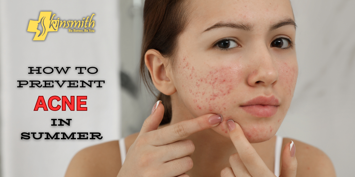 How To Prevent Acne In Summers: Your Ultimate Guide to Clear Skin - Dr ...